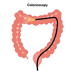 Colonoscopy Prep Made Simple: Tips for a Smoother Experience